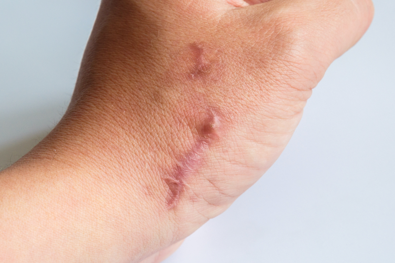 Keloid And Hypertrophic Scarring Laser Skin Care Keloid And Hypertrophic Scarring Laser Skin Care