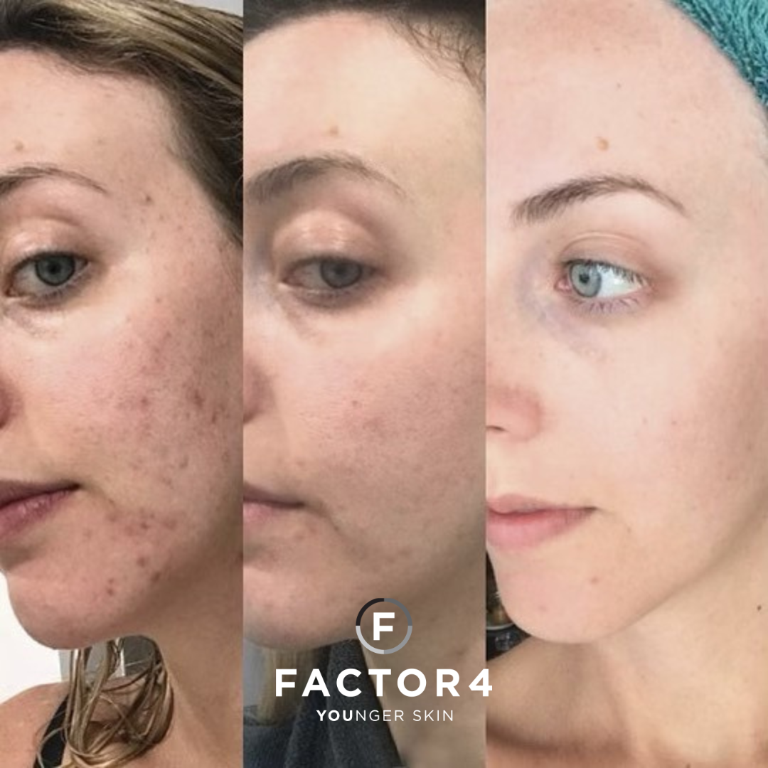 Factor4 Laser Skin Care Factor4 Laser Skin Care
