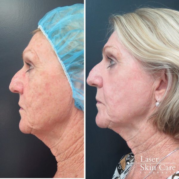 Ultrapulse Fractional CO2 Laser ActiveFX & DeepFX - Laser Skin Care