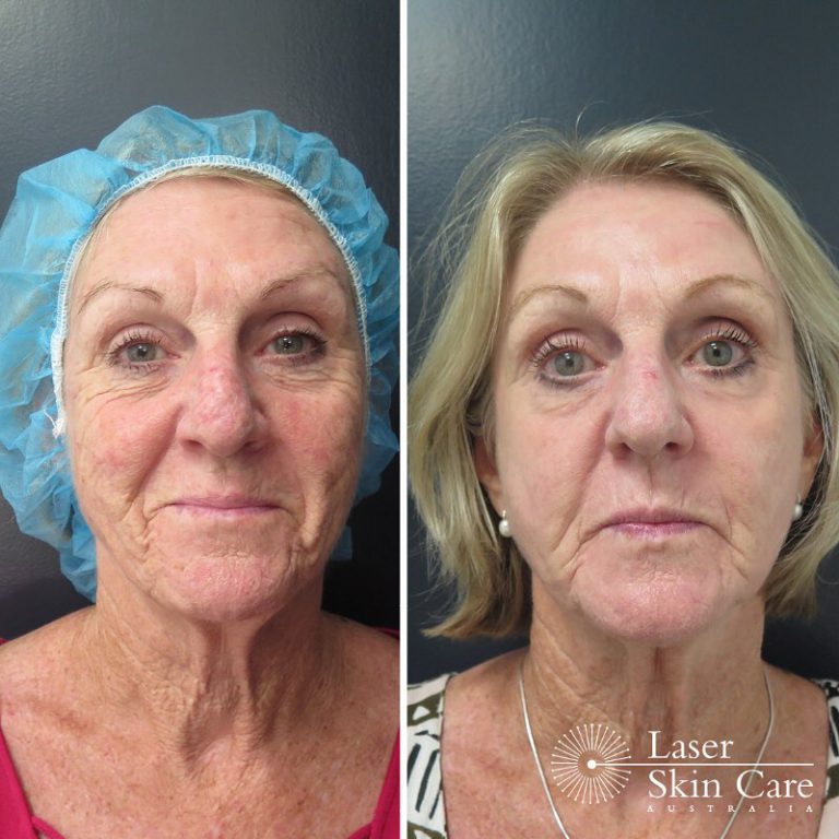 Ultrapulse Fractional CO2 Laser ActiveFX & DeepFX - Laser Skin Care