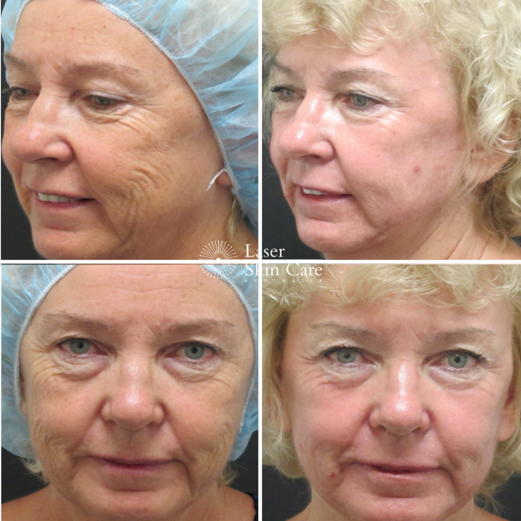 Ultrapulse Fractional CO2 Laser ActiveFX & DeepFX - Laser Skin Care